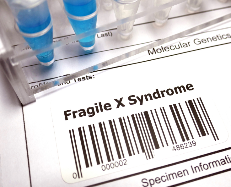 Fragile X Syndrome — Everything You Need to Know